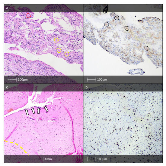 Pathomorphological Diagnostic Criteria for Focal Cortical Dysplasias ...