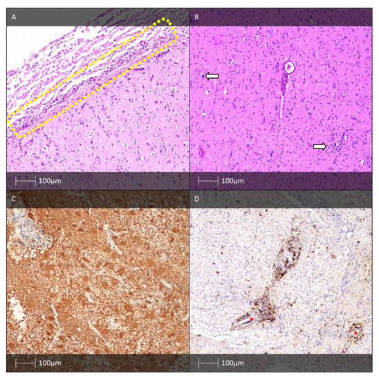 Pathomorphological Diagnostic Criteria for Focal Cortical Dysplasias ...