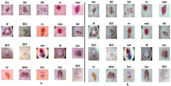 AI Techniques of Dermoscopy Image Analysis for the Early Detection of ...