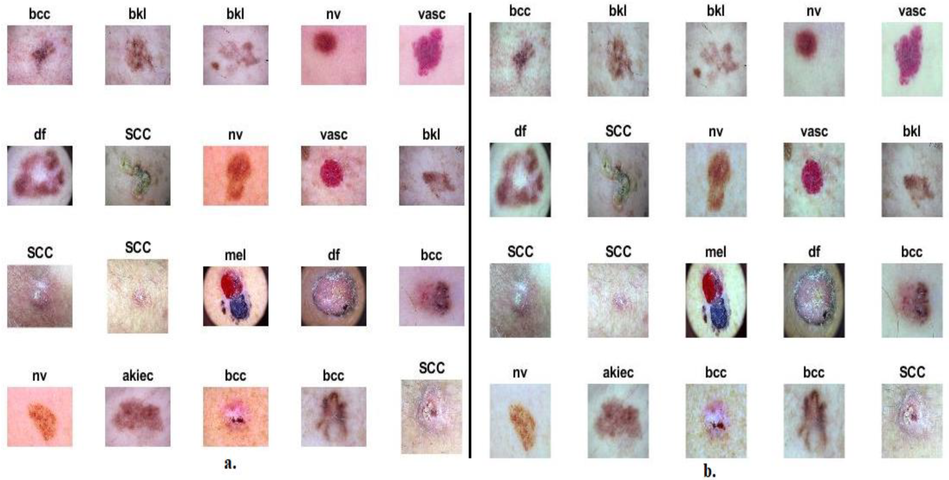 Skin Lesion Classification Using Multi Resolution Empirical 44 Off