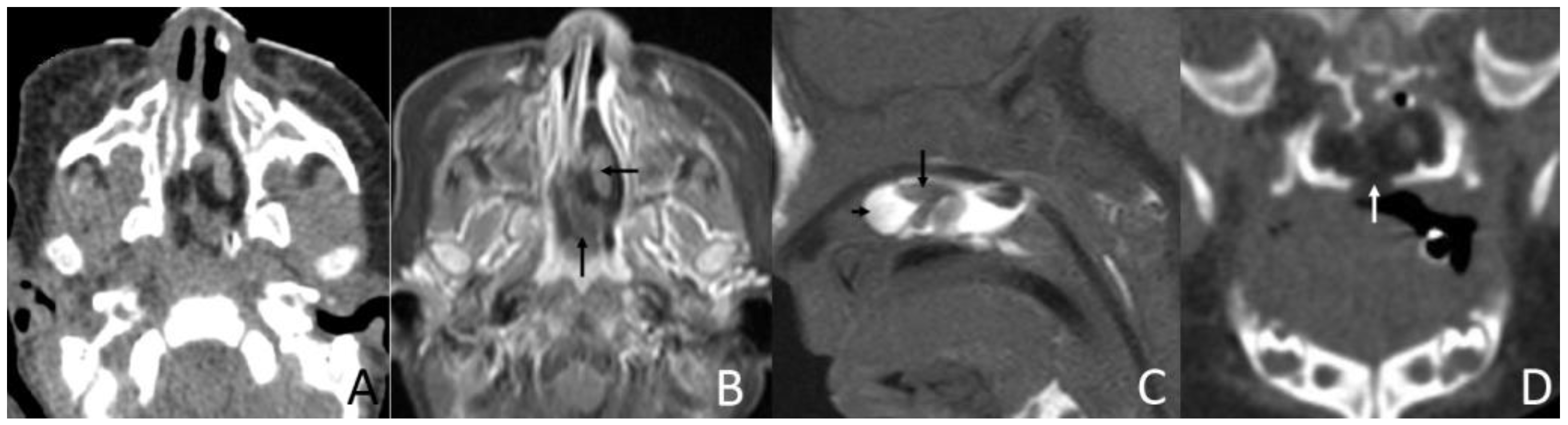 CT and MRI Features of Hairy Polyps in Neonates and Infants: A ...