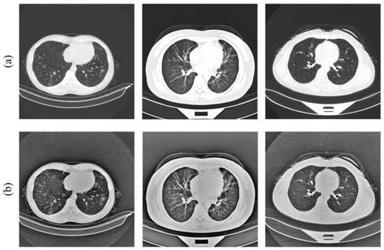 Deep-Learning-Based COVID-19 Diagnosis and Implementation in Embedded Edge-Computing Device
