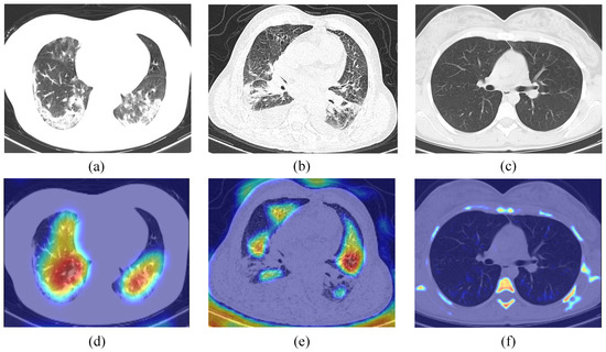 Deep-Learning-Based COVID-19 Diagnosis and Implementation in Embedded Edge-Computing Device