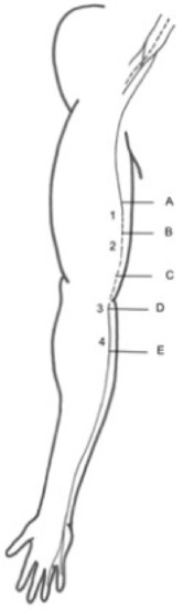 Diagnostics Free Full Text Possible Points Of Ulnar Nerve Entrapment In The Arm And Forearm