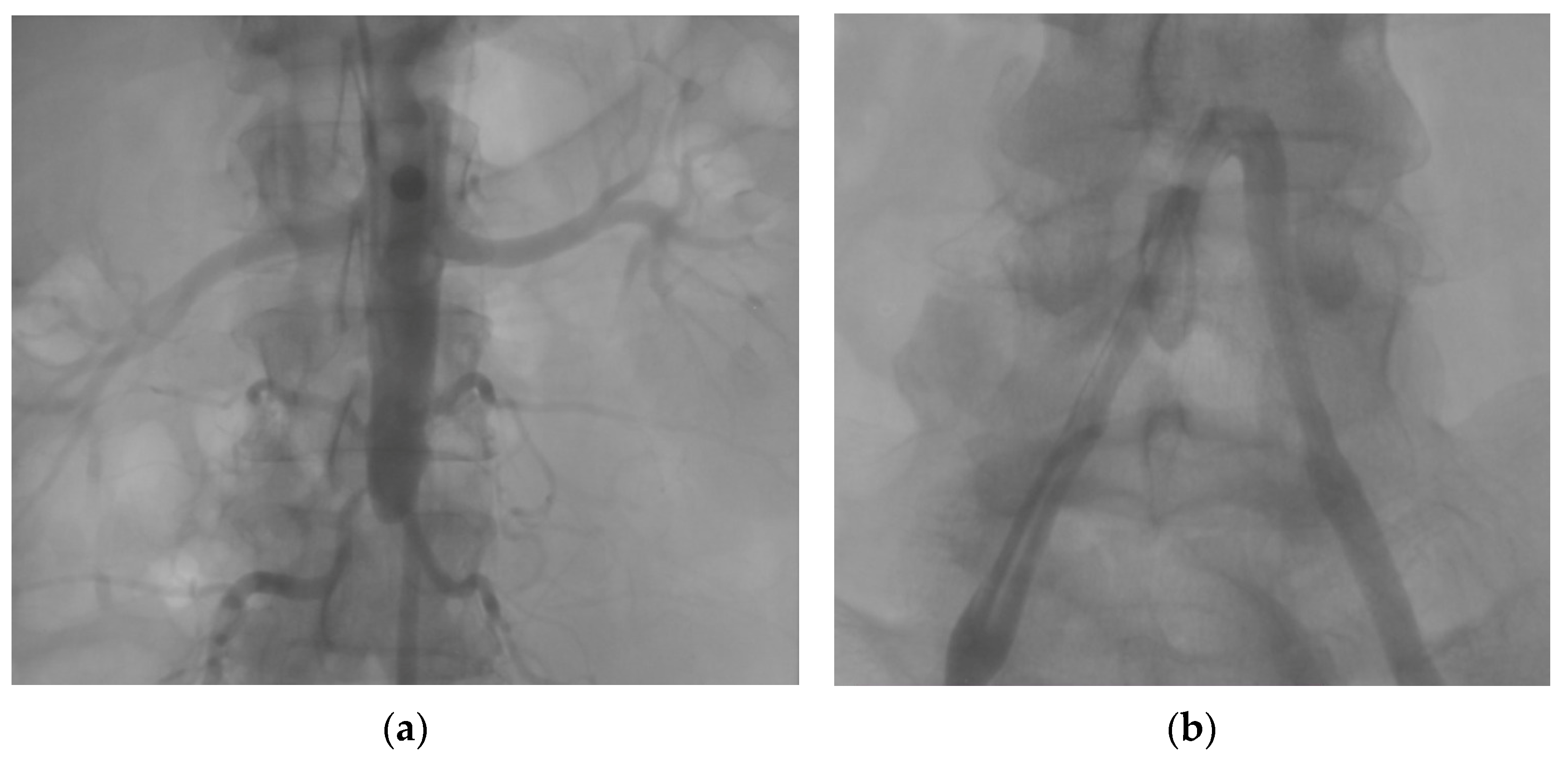 Chronic Complete Distal Aortic Occlusion and Pulmonary Embolism—Atypical Antiphospholipid Syndrome?