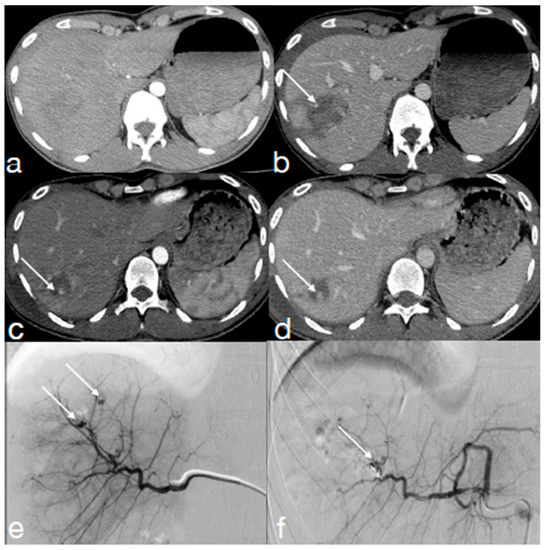 Non-Operative Management of Polytraumatized Patients: Body Imaging ...