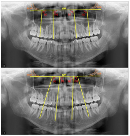 Comparison of the Mesiodistal Angulations of Canine and Molar Teeth in ...