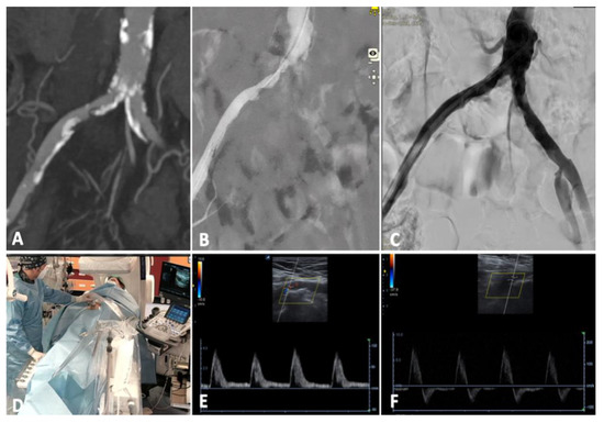 Extravascular Ultrasound (EVUS) to Assess the Results of Peripheral ...