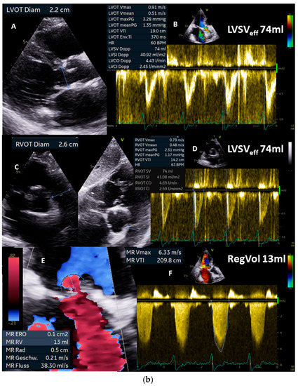 Valid and Reproducible Quantitative Assessment of Cardiac Volumes by ...