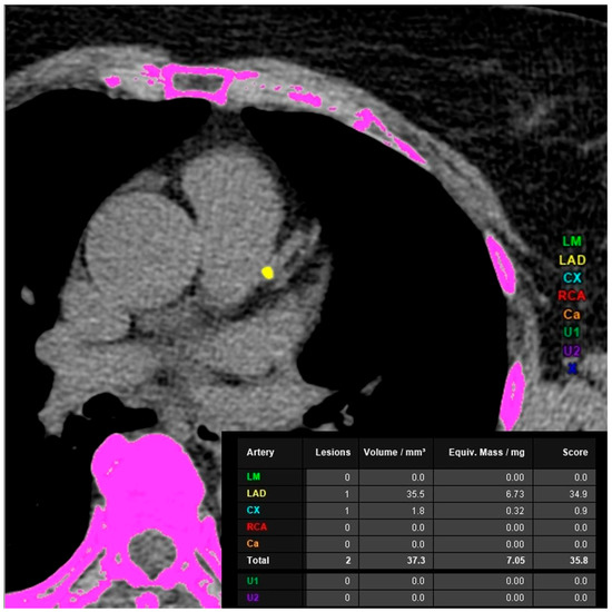 Single Coronary Artery as a Rare Developmental Variant in Cardiac Computed Tomography Angiography