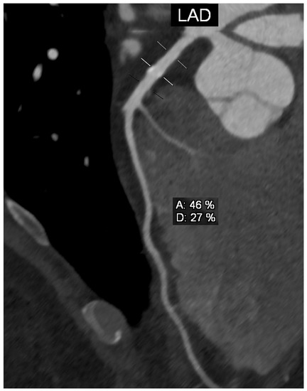 Single Coronary Artery as a Rare Developmental Variant in Cardiac ...