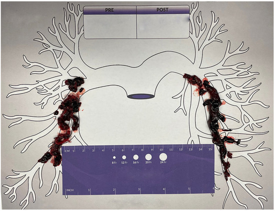 Use of Autotransfusion following Percutaneous Thrombectomy for ...