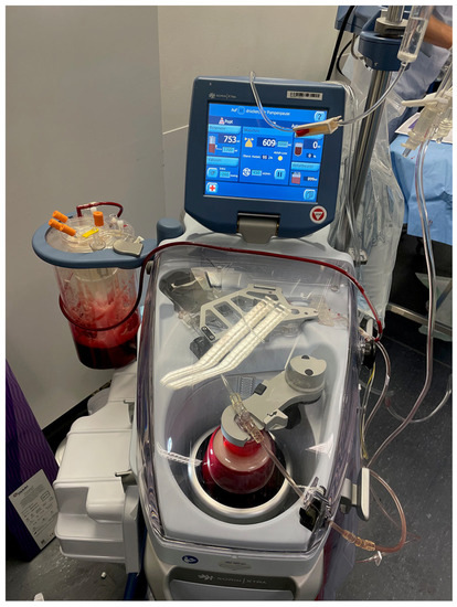 Use of Autotransfusion following Percutaneous Thrombectomy for ...