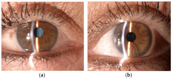 Management of Spontaneous Crystalline Lens Luxation in a Patient ...