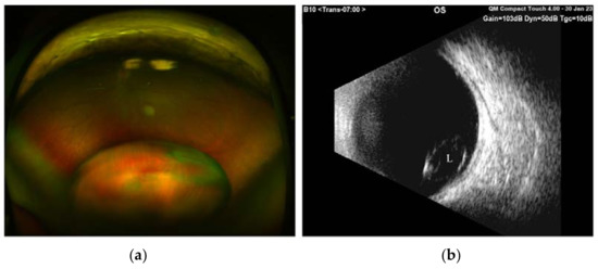 Management of Spontaneous Crystalline Lens Luxation in a Patient ...