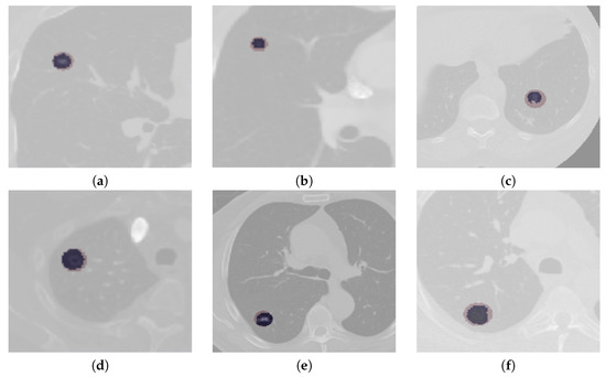 Diagnostics | Free Full-Text | A Bi-FPN-Based Encoder–Decoder Model for Lung Nodule Image ...
