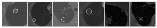 Diagnostics | Free Full-Text | A Bi-FPN-Based Encoder–Decoder Model for Lung Nodule Image ...