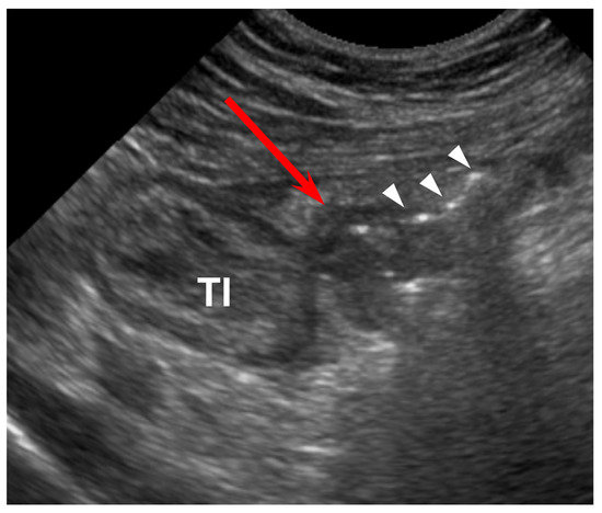 Acute Ileal Diverticulitis: Computed Tomography and Ultrasound Findings