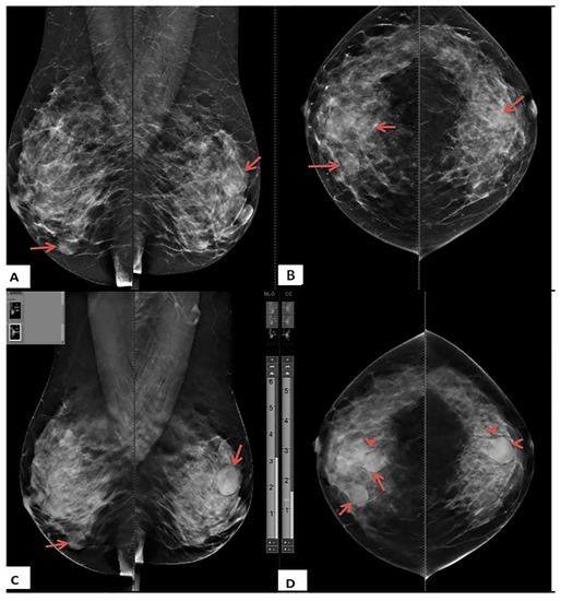 The Impact of Adding Digital Breast Tomosynthesis to BI-RADS ...