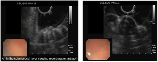 Endoscopic Ultrasound View of Pneumatosis Cystoides Intestinalis