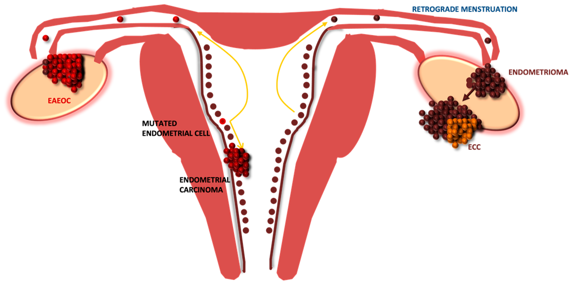 Endometriosis-Related Ovarian Cancers: Evidence for a Dichotomy in the Histogenesis of the Two ...
