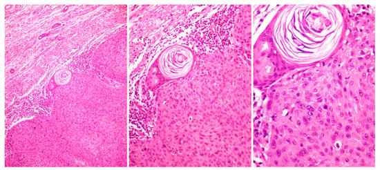 Eccrine Porocarcinoma: A Review of the Literature
