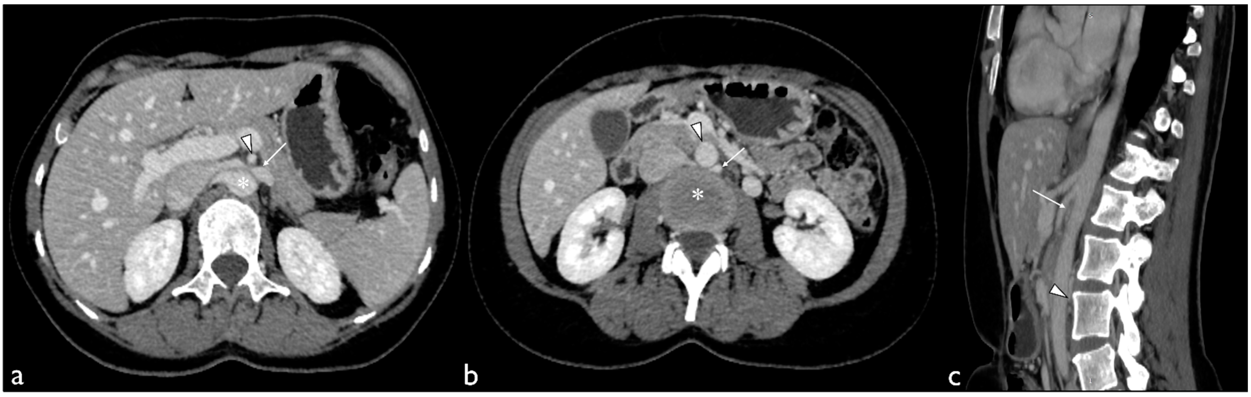 Diagnostics Free Full Text Anterior And Posterior Nutcracker