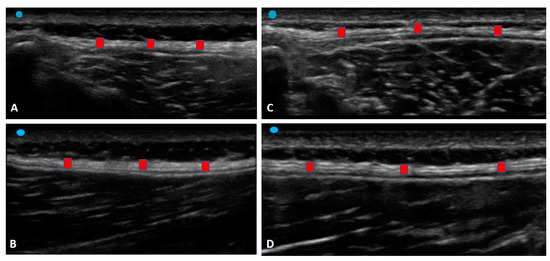 Ultrasound Imaging of Thoracolumbar Fascia Thickness: Chronic Non ...