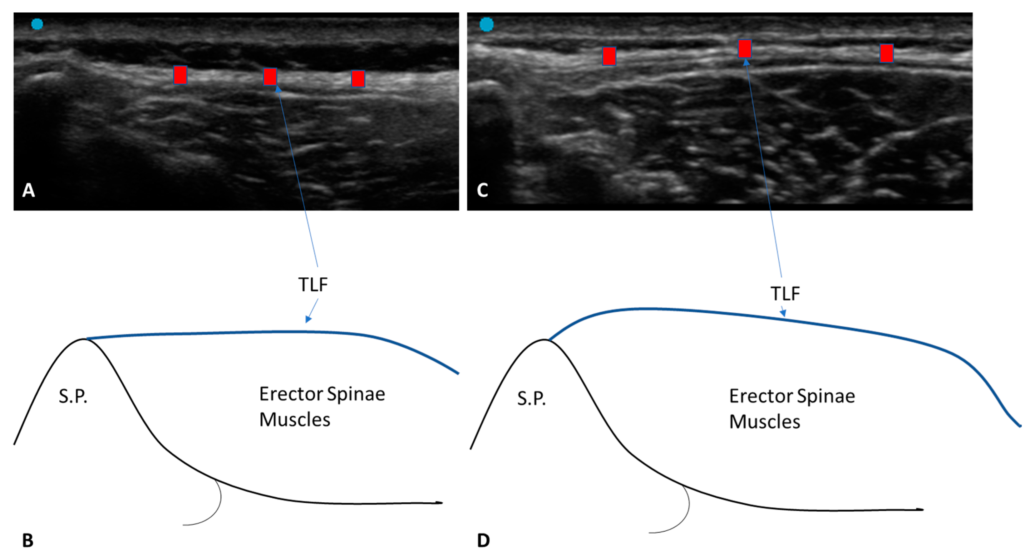 Ultrasound Imaging of Thoracolumbar Fascia Thickness: Chronic Non ...
