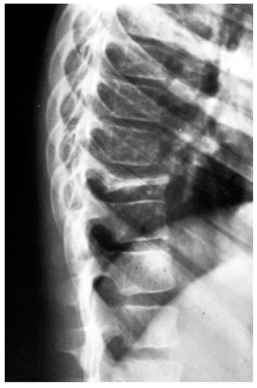 Diagnostics | Free Full-Text | Vertebra Plana: A Narrative Clinical and ...