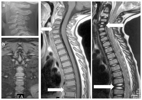 Vertebra Plana: A Narrative Clinical and Imaging Overview among ...