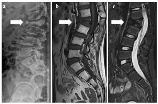 Diagnostics | Free Full-Text | Vertebra Plana: A Narrative Clinical and ...