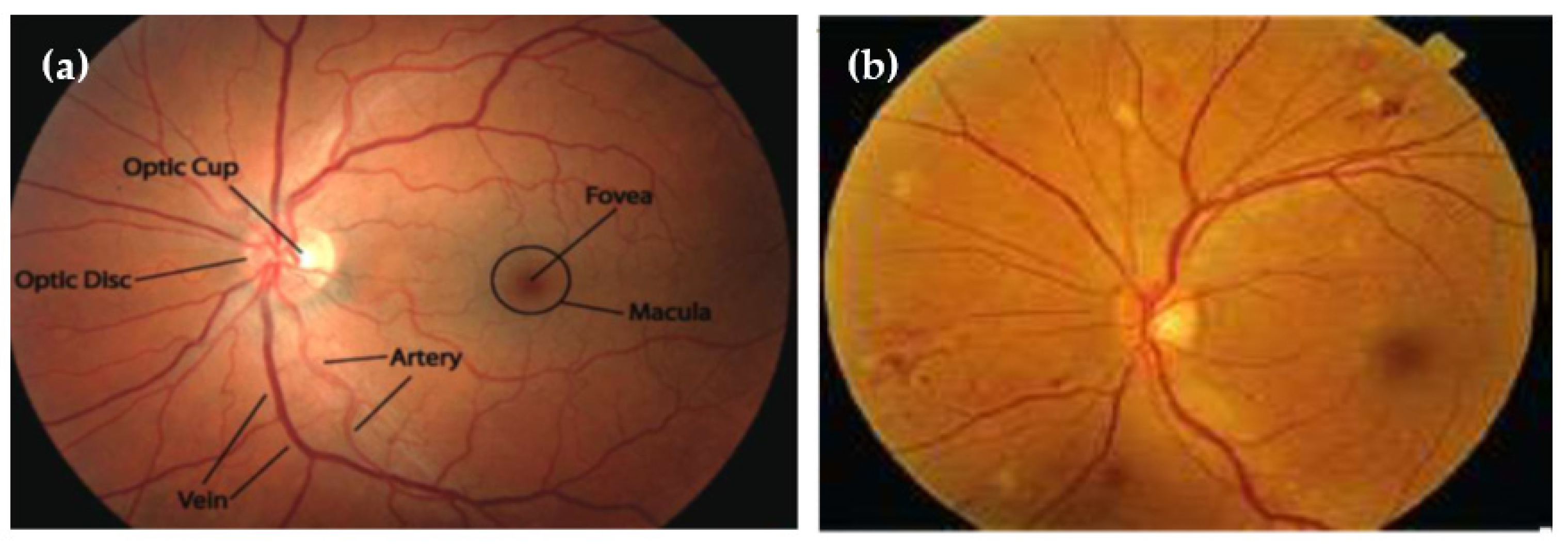 Mild Hypertensive Retinopathy Mild Hypertensive Retinopathy