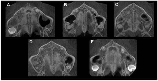 Midpalatal Suture Maturation Stage in 10- to 25-Year-Olds Using Cone ...