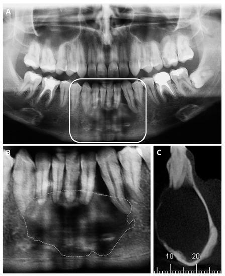 Glandular Odontogenic Cyst in the Anterior Mandible: A Case Report of a ...