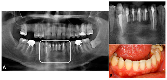Glandular Odontogenic Cyst in the Anterior Mandible: A Case Report of a ...