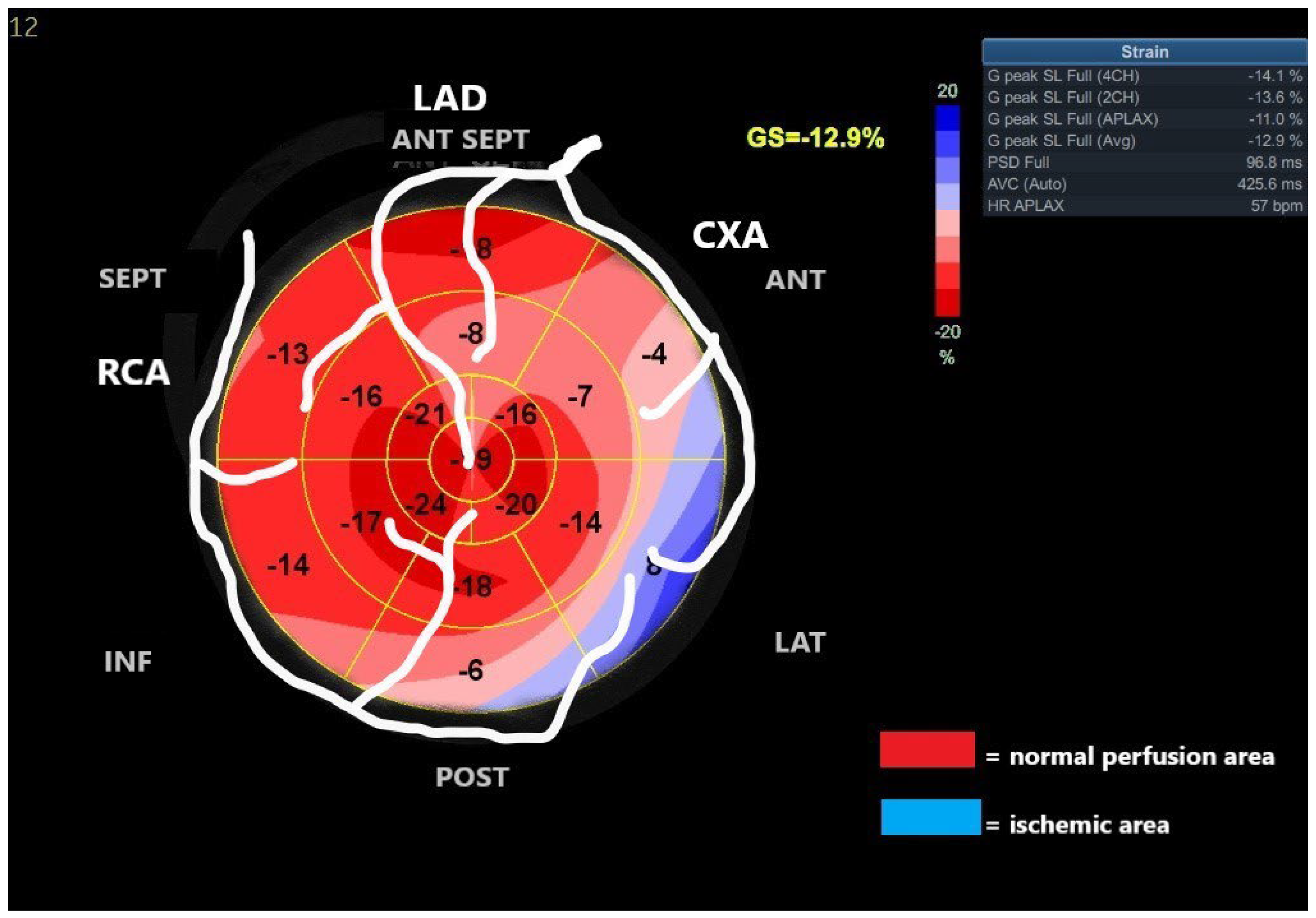 Diagnostics | Free Full-Text | Myocardial Work Evaluation—A Useful Non ...