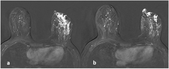 Idiopathic Granulomatous Mastitis or Breast Cancer? A Comparative MRI ...