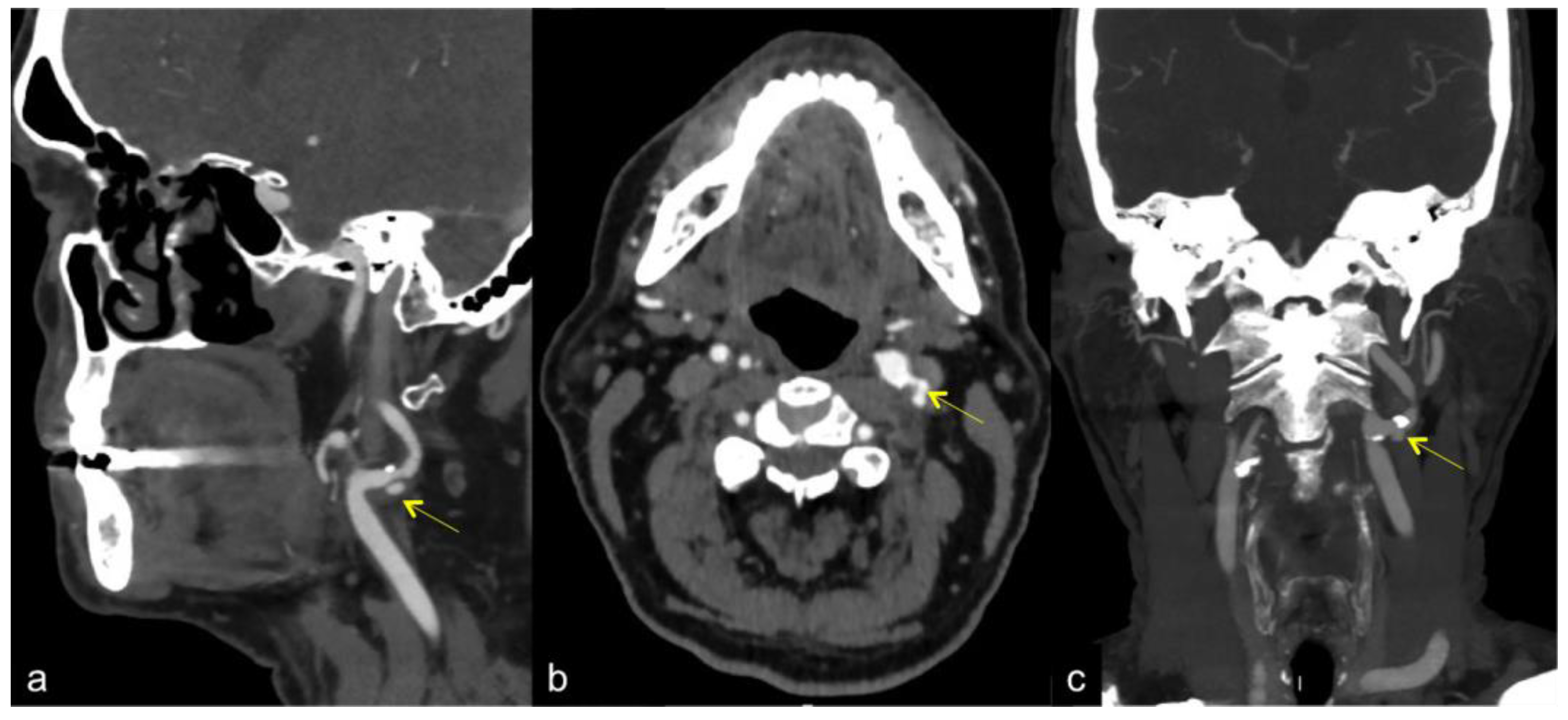 Treatment Enlarged Carotid Bulb