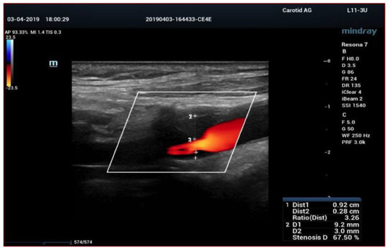 New Technologies in the Assessment of Carotid Stenosis: Beyond the ...