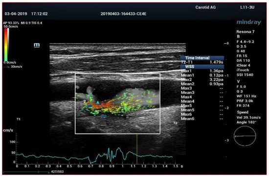 New Technologies in the Assessment of Carotid Stenosis: Beyond the ...