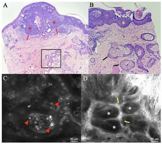 Nevus Sebaceous of Jadassohn in Adults—Can Reflectance Confocal ...