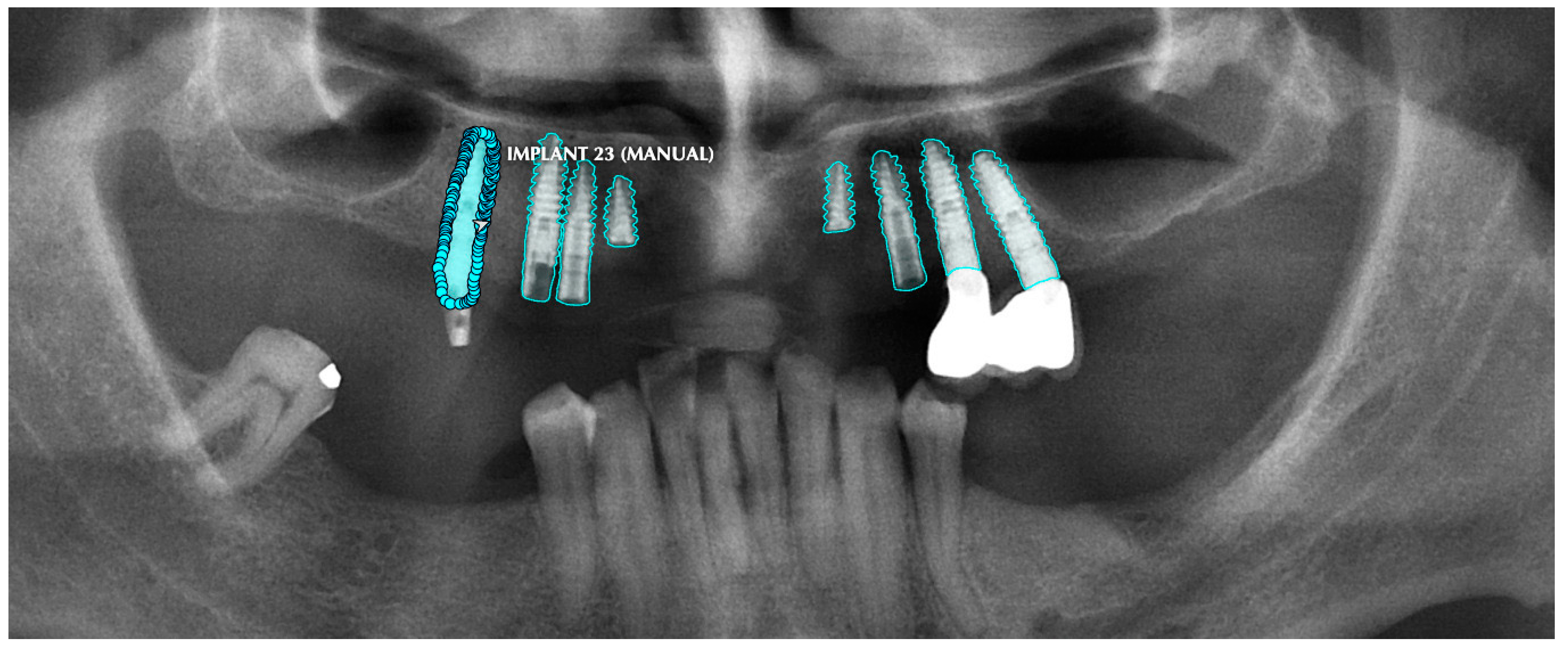 Automatic Segmentation of Teeth, Crown–Bridge Restorations, Dental Implants, Restorative ...