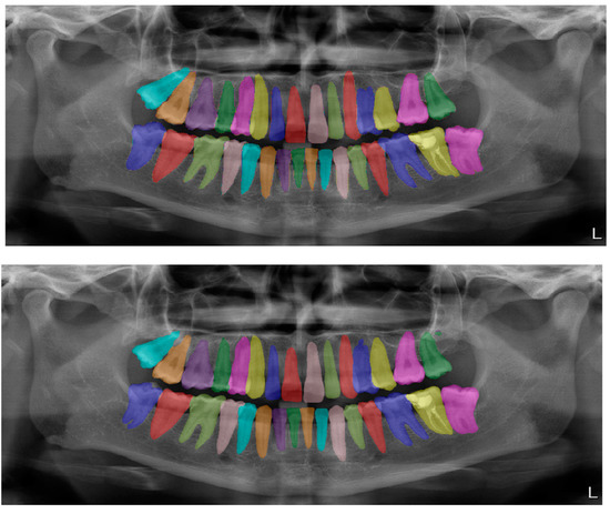 Automatic Segmentation of Teeth, Crown–Bridge Restorations, Dental Implants, Restorative ...