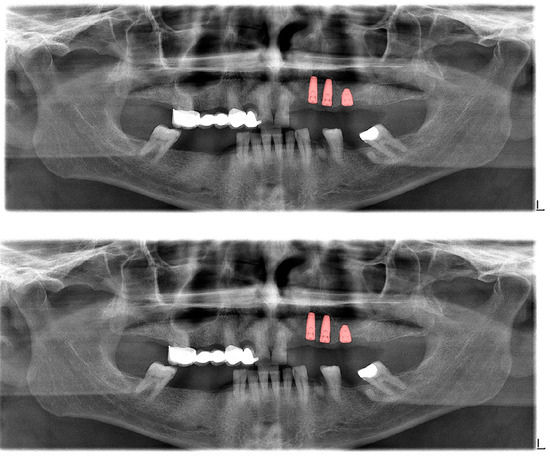 Automatic Segmentation of Teeth, Crown–Bridge Restorations, Dental ...