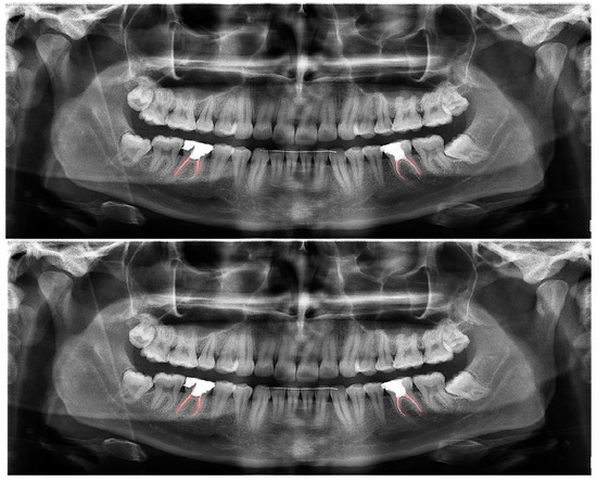 Automatic Segmentation of Teeth, Crown–Bridge Restorations, Dental ...