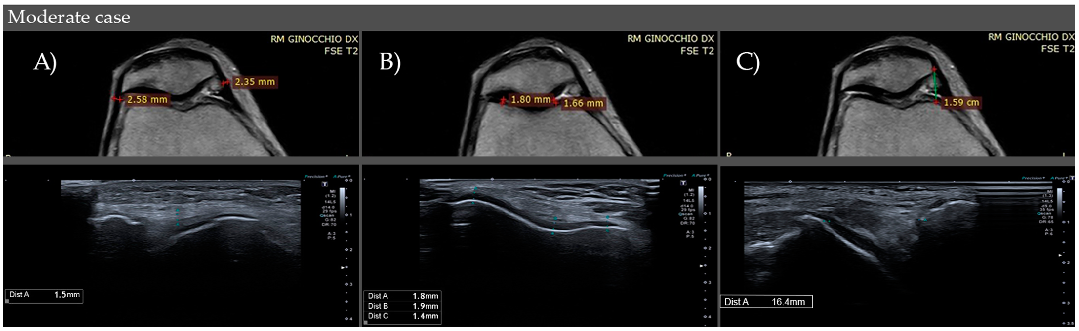 Patello-Femoral Pain Syndrome: Magnetic Resonance Imaging versus Ultrasound