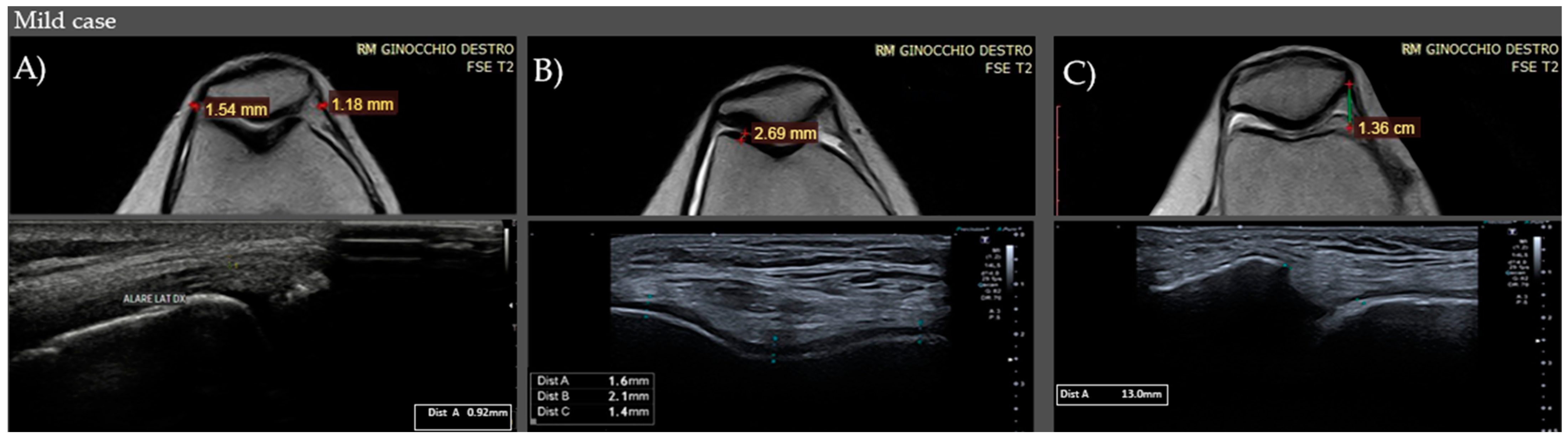 Patello-Femoral Pain Syndrome: Magnetic Resonance Imaging versus Ultrasound