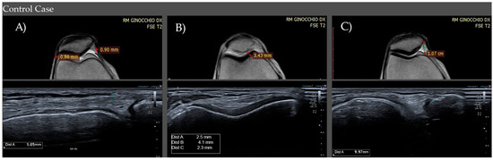 Patello-Femoral Pain Syndrome: Magnetic Resonance Imaging versus Ultrasound