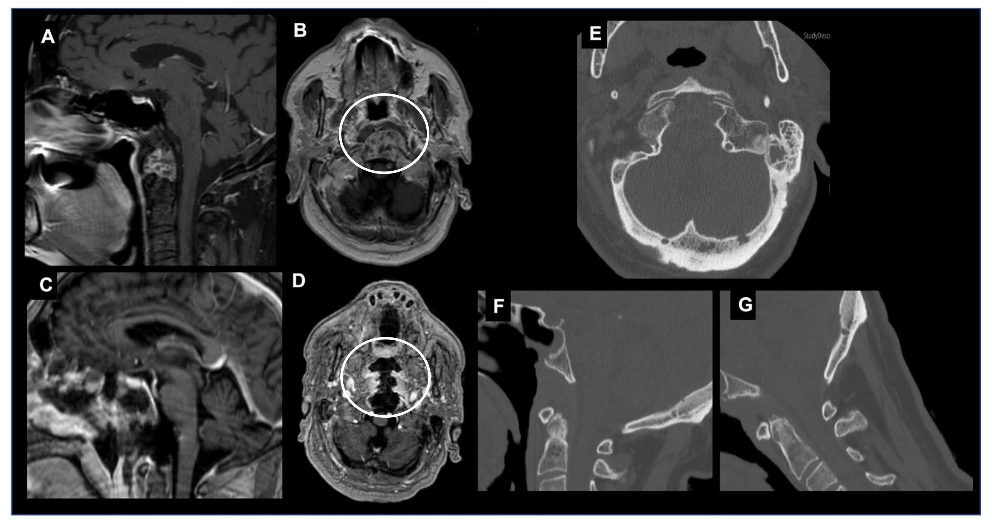 Craniovertebral Junction Instability after Oncological Resection: A ...